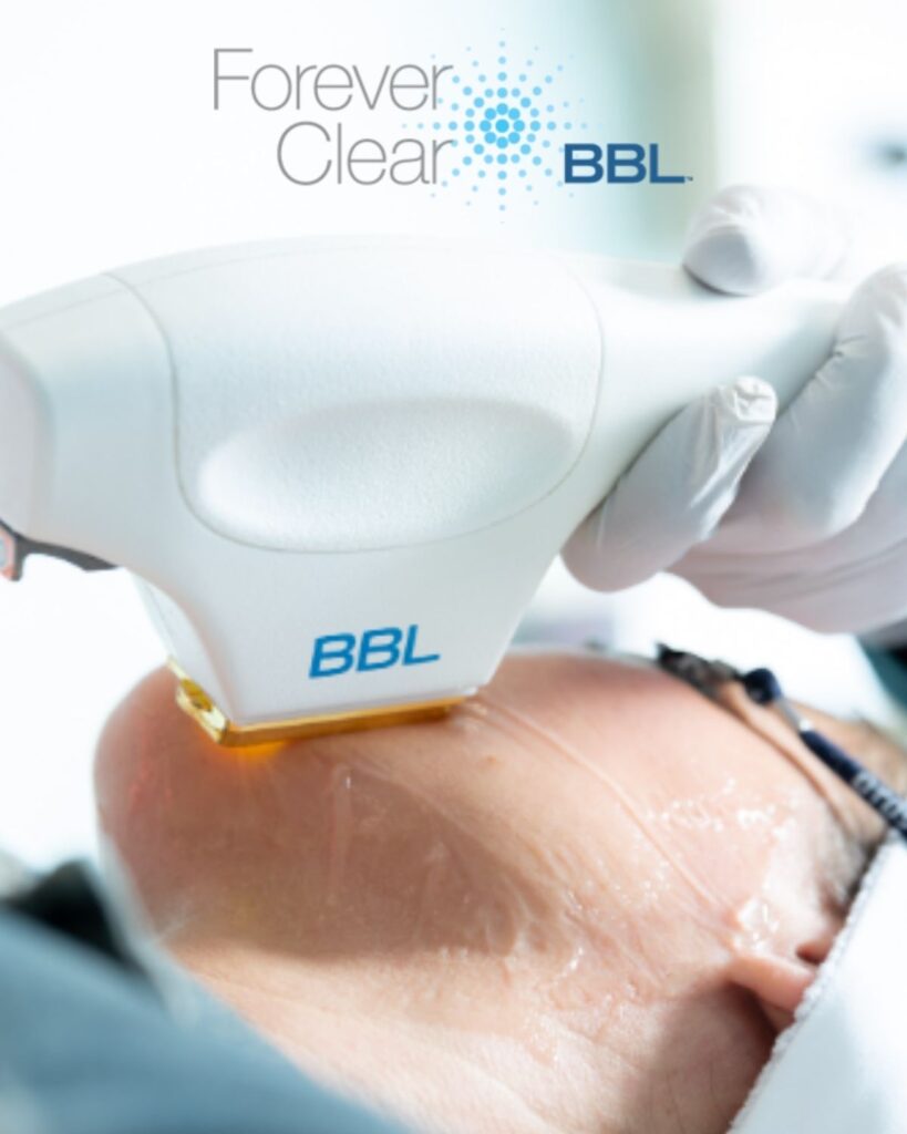 BBL Forever Clear for Men – Radiance Medspa Louisville